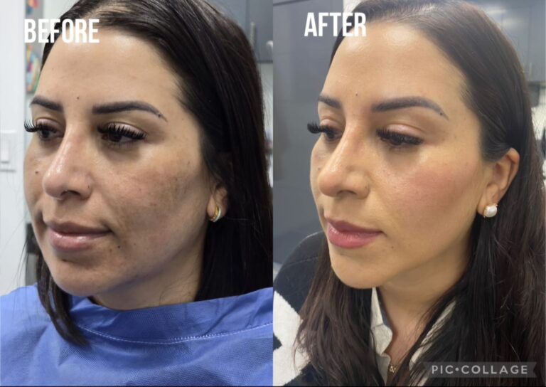 Non-Surgical Facial Treatments - Go Fillers Tijuana